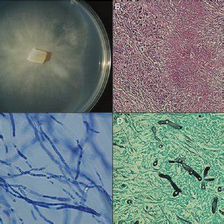 PDF Pythium Insidiosum A Rare Necrotizing Orbital And Facial Infection