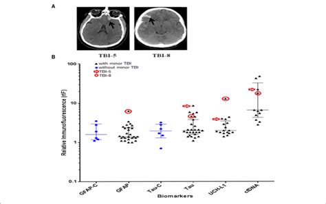 A Ct Scan Images Showing Contusion In Patient 5 And 8 With Minor