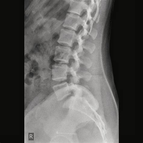 X Ray Image Of Lumbosacral Spine Lateral View Lamber Spine Lateral