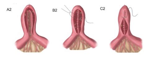 Stricturoplasty The Operative Review Of Surgery