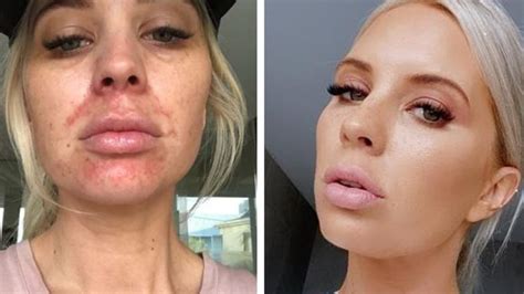Unusual Thing Saved Mum From Horrifying Facial Rash News Com Au Australias Leading News