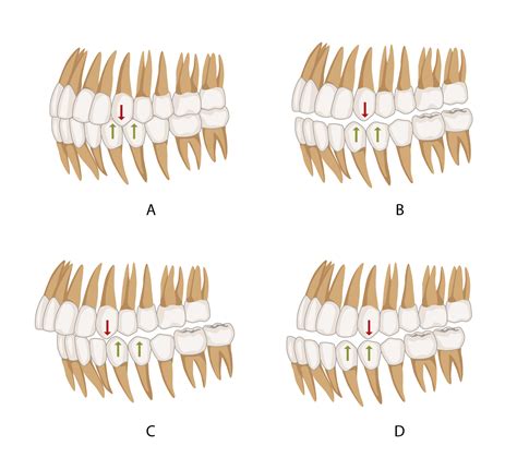 Normal Occlusion Vs Class 1 At Peggy Rios Blog