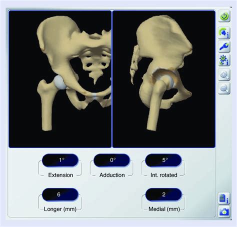 Intraoperative Leg Length And Offset Measurements Obtained With An Download Scientific Diagram