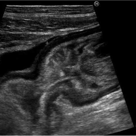 Endoscopy Image Of The Ileocecal Valve With Markedly Increased