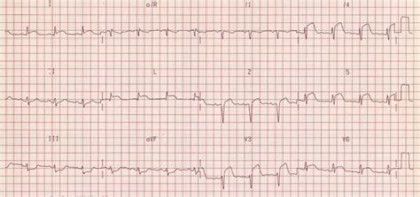 Differentiating Normal Early St Repolarization Versus Left Anterior Stemi Pemblog