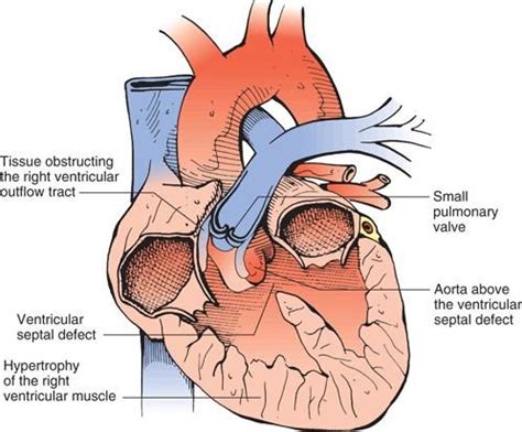 Right Ventricular Outflow Tract Anatomy
