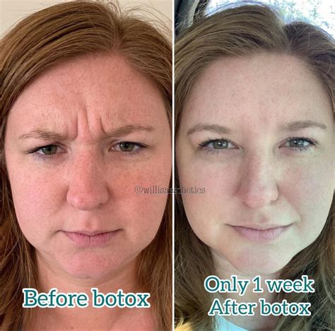 Botox 1 Week Willis Cosmetic Surgery Botox Ballwin