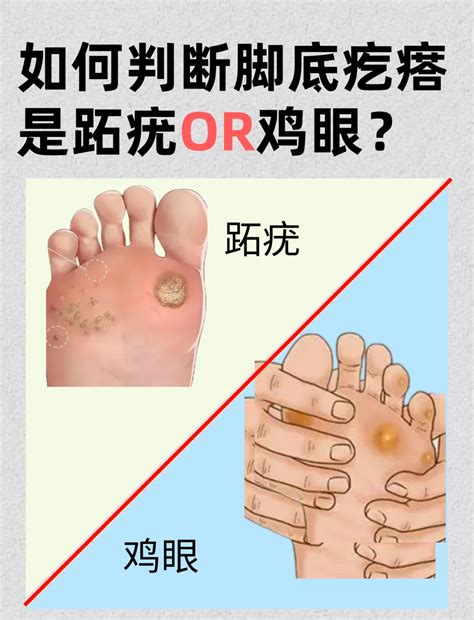跖疣和鸡眼怎么区分？