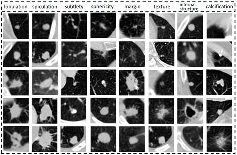 A Synthesizing Semantic Characteristics Lung Nodules Classification Method Based On 3d