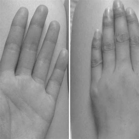 The Skin Hyperpigmentation Of Upper Limbs Download Scientific Diagram