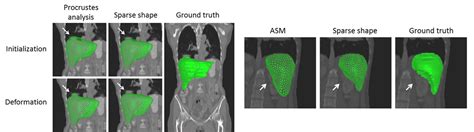 deformable segmentation and robust shape prior modeling