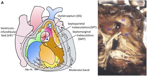 Diagram And Gross Dissection Of The Right Ventricle In Tetralogy Of