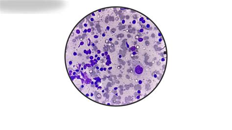 Bl Cervical Lymphadenopathy Case 29pptx
