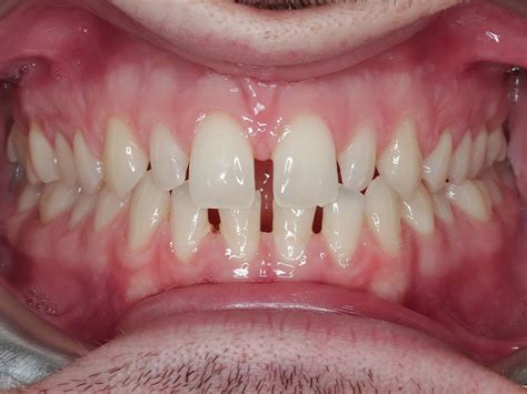 What Is A Frenectomy Procedure Results And Cost 3dental