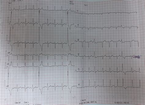 Ventricular Quadrigeminy