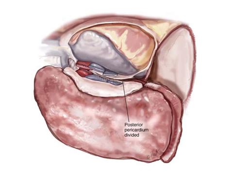 Pneumonectomy Baylor Medicine