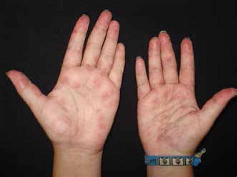 Coccidioidomycosis Skin