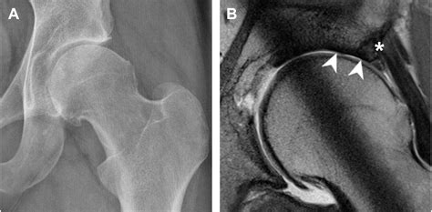 Femoroacetabular Impingement Magnetic Resonance Imaging Clinics