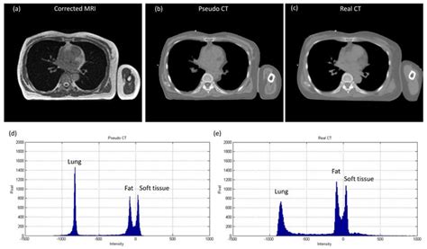 Applying Mri Intensity Normalization On Non Bone Tissues To Facilitate