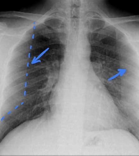 Cxr Interpretation Flashcards Quizlet