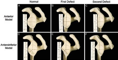 Figure 1 From Quantifying Glenoid Bone Loss In Anterior Shoulder