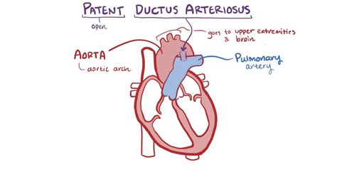Ductus Arteriosus