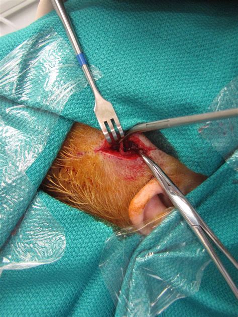 Temporal Arteritis Giant Cell Arteritis And Temporal Artery Biopsy