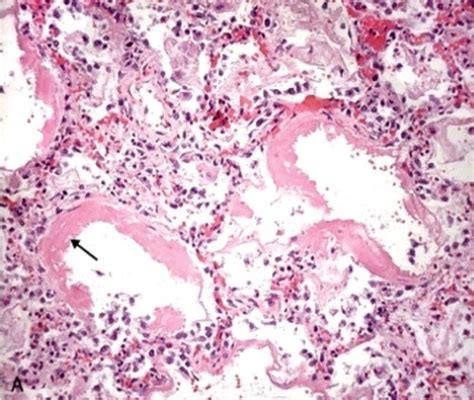Pathology Block 4 Flashcards Quizlet