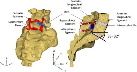 Patient Specific Finite Element Model Ss 32° With The Pars Region