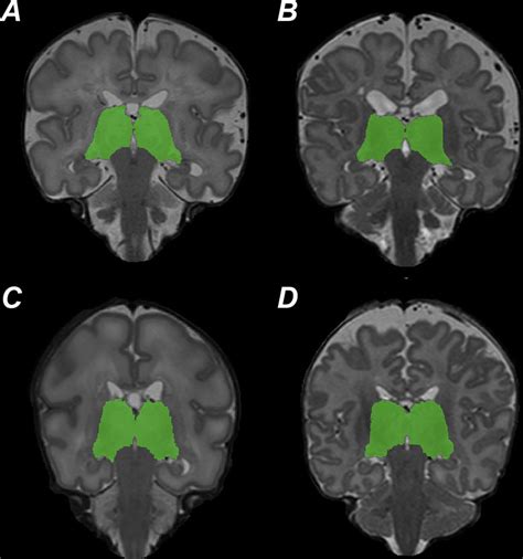 Thalamic Segmentations The Upper Row Represents A Male Infant Born At