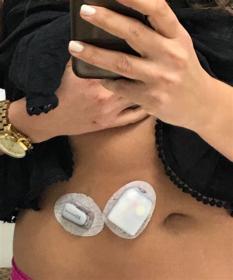 Are My Dexcom And Omnipod Too Close To Each Other Rdiabetest1
