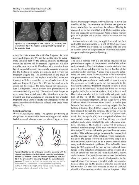 Solution Percutaneous Reduction And Fixation Of An Intra Articular Calcaneal Fracture Using An