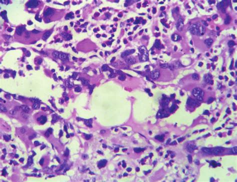 Megakaryocytes With Pleomorphic Nuclei Download Scientific Diagram