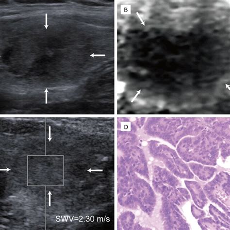 Images In A 56 Year Old Woman With Nodular Goiter Without Highly Download Scientific Diagram