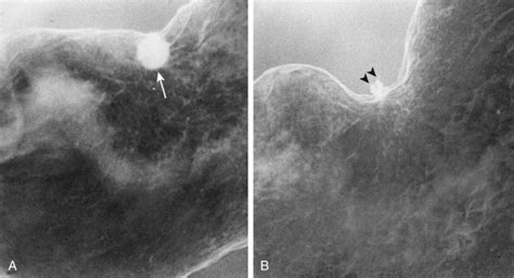 Peptic Ulcers Radiology Key
