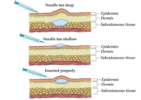 Intradermal Injection Technique Mesotherapy Skin Boosters Botox And Filler Injector
