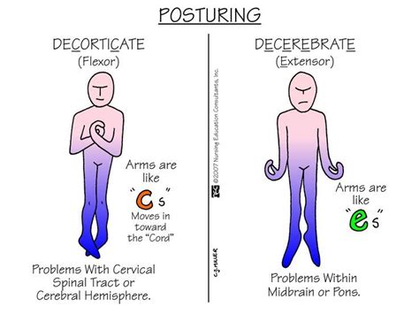 Decorticate Vs Decerebrate Posturing Posturing Medical Surgical Nursing Nursing Mnemonics