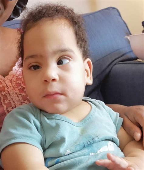 Botox For Strabismus Rcerebralpalsy