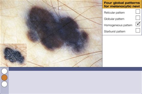Pattern Analysis Dermoscopic Criteria For Specific Diagnoses Plastic Surgery Key