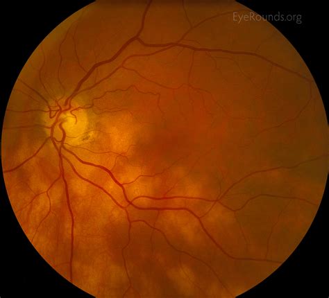 Atlas Entry Sarcoidosis With Choroidal Infiltrates