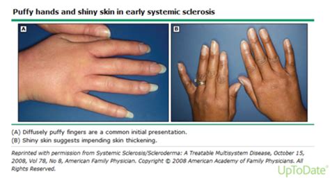 Scleroderma Flashcards Quizlet