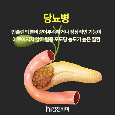 당뇨병의 종류가 2가지 제1형과 제2형의 차이점은 무엇일까요 건강검진정보