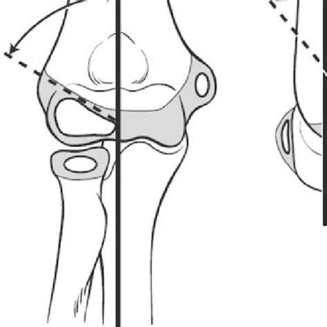 Fracture Displacement Measures For The Humerocapitellar Angle Are Download Scientific Diagram