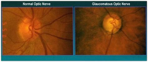 Glaucoma Treatment Detroit Troy And Macomb Eye Care