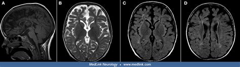 Pyridoxine Deficiency And Toxicity Medlink Neurology