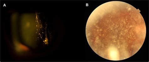 Spotlight On Asteroid Hyalosis A Clinical Perspective Pmc