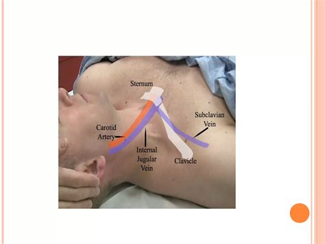 Central Venous Lines And Their Problems Ppt