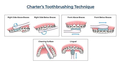 Toothbrushing Techniques Choosing The Best Method For Patients