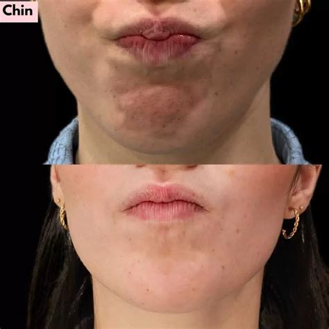 Chin Botox The Secret To A Defined Jawline
