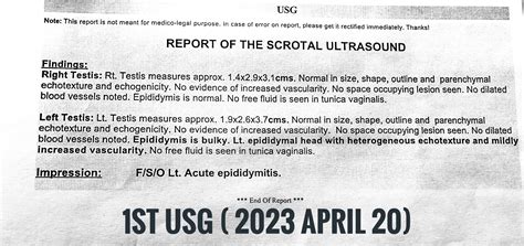 Left Epididymo Orchitis With Left Funiculitis R Chronicepididymitis